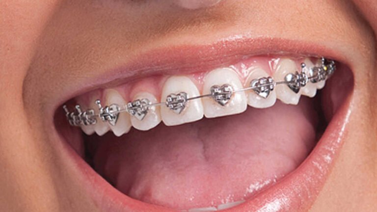 Signs That You Need An Orthodontic Treatment - PVPD Arizona