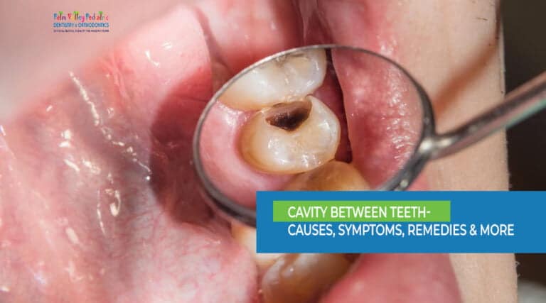 Cavity Between Teeth: Causes, Symptoms, Remedies & More