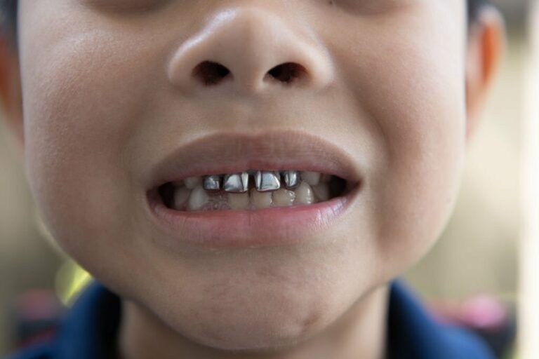 Silver Teeth for Kids in Scottsdale [Cost, Safety, Signs, Treatment]