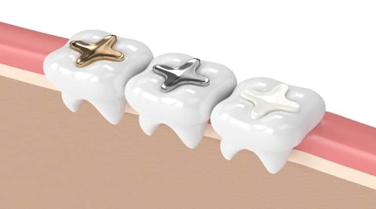Tooth Colored Fillings: Procedure, Safety, Benefits and Drawbacks