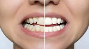 Messed Up Teeth - Causes, Treatment, and Much More!