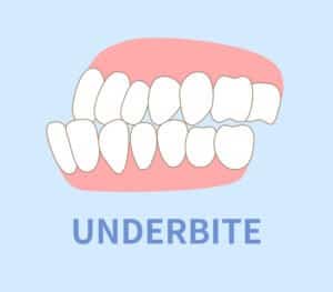 Underbite in children: Causes, Symptoms and Treatment - PVPD