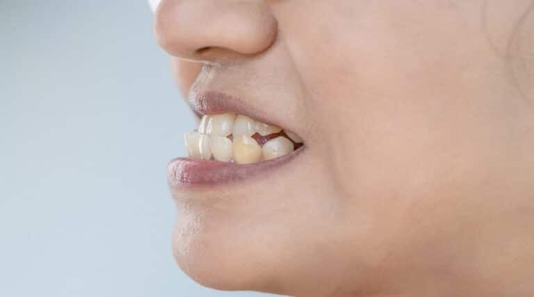 Underbite in children: Causes, Symptoms and Treatment - PVPD