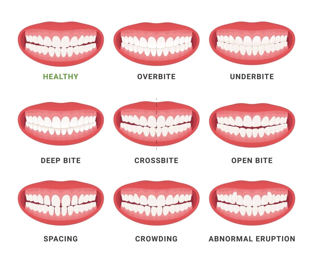 Underbite In Children Causes Symptoms And Treatment PVPD Underbite In Children Causes Symptoms And Treatment PVPD
