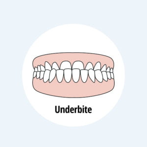 Underbite in children: Causes, Symptoms and Treatment - PVPD