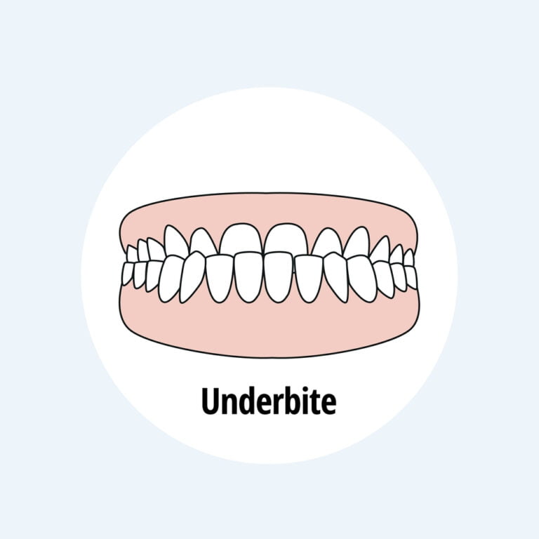 Underbite in children: Causes, Symptoms and Treatment - PVPD