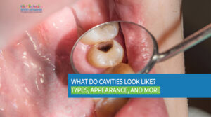 What Do Cavities Look Like? Types, Appearance, and More