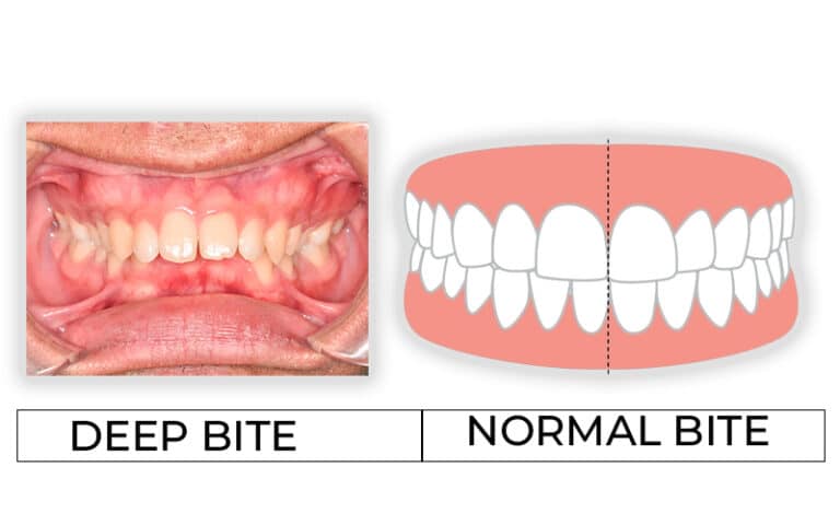Deep Bite: Causes, Symptoms, Treatment & More!