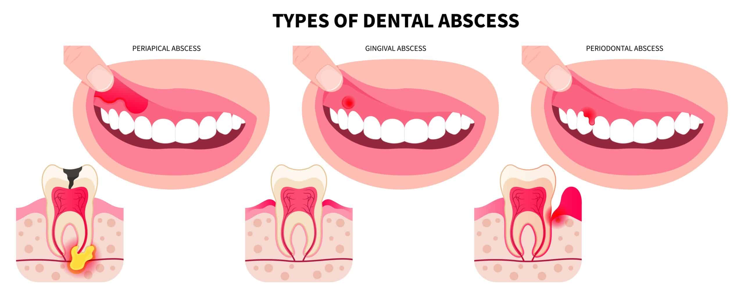 Tooth Abscess Types Infoupdate Tooth Abscess Types Infoupdate