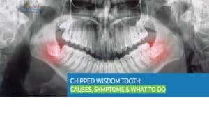 Chipped Wisdom Tooth: Causes, Symptoms & What to Do