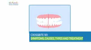 Crossbite 101: Symptoms, Causes, Types and Treatment